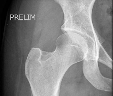 Hip Impingement - University of Toronto Orthopaedic Sports Medicine – UTOSM