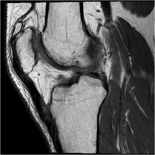 Quadriceps Tear - University of Toronto Orthopaedic Sports Medicine – UTOSM