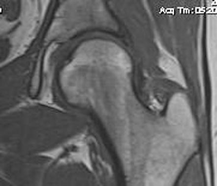 Hip Impingement - University of Toronto Orthopaedic Sports Medicine – UTOSM
