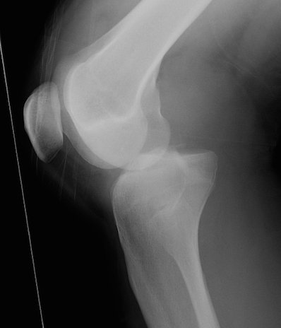 Patellar Dislocation - University of Toronto Orthopaedic Sports ...