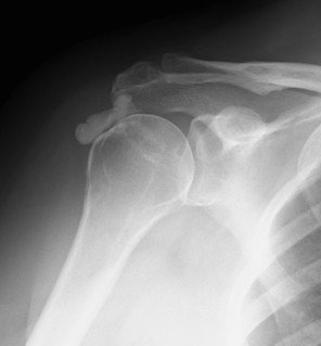 Calcific Tendonitis - University of Toronto Orthopaedic Sports Medicine ...