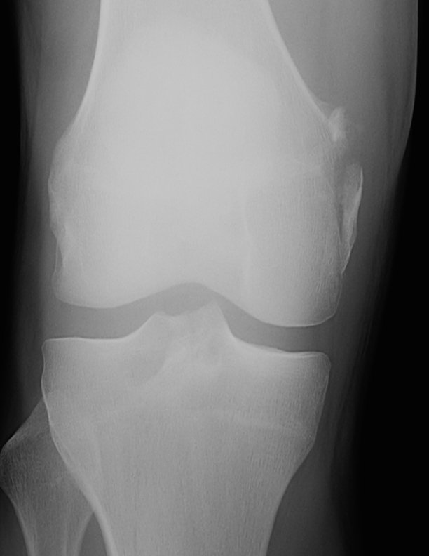 MCL Tear - University of Toronto Orthopaedic Sports Medicine – UTOSM