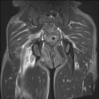 Hamstring Injury / Rupture - University of Toronto Orthopaedic Sports ...