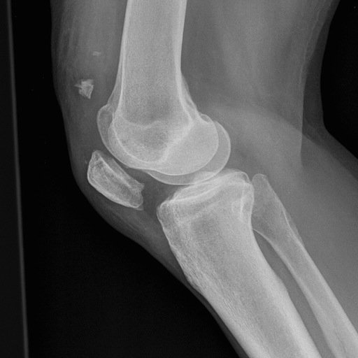 Quadriceps Tear - University of Toronto Orthopaedic Sports Medicine – UTOSM