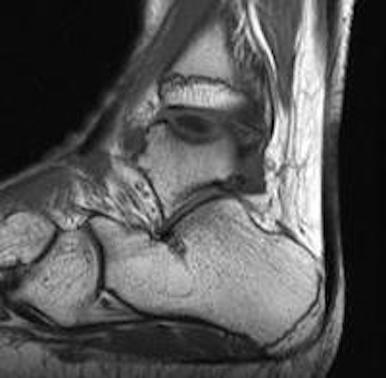 Ankle OCD - University of Toronto Orthopaedic Sports Medicine – UTOSM