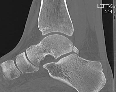 Ankle Impingement - University of Toronto Orthopaedic Sports Medicine ...