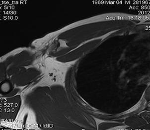 Pectoralis Major Tear - University of Toronto Orthopaedic Sports ...